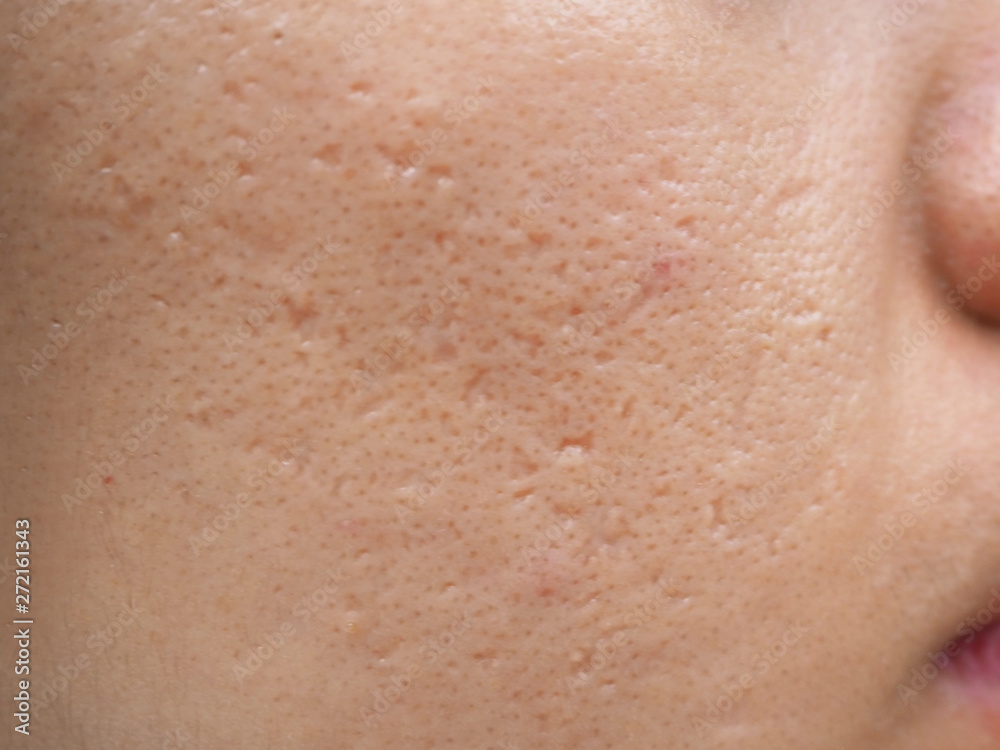 icepick scar acne on cheek on face women cause of skin loses collagen ...