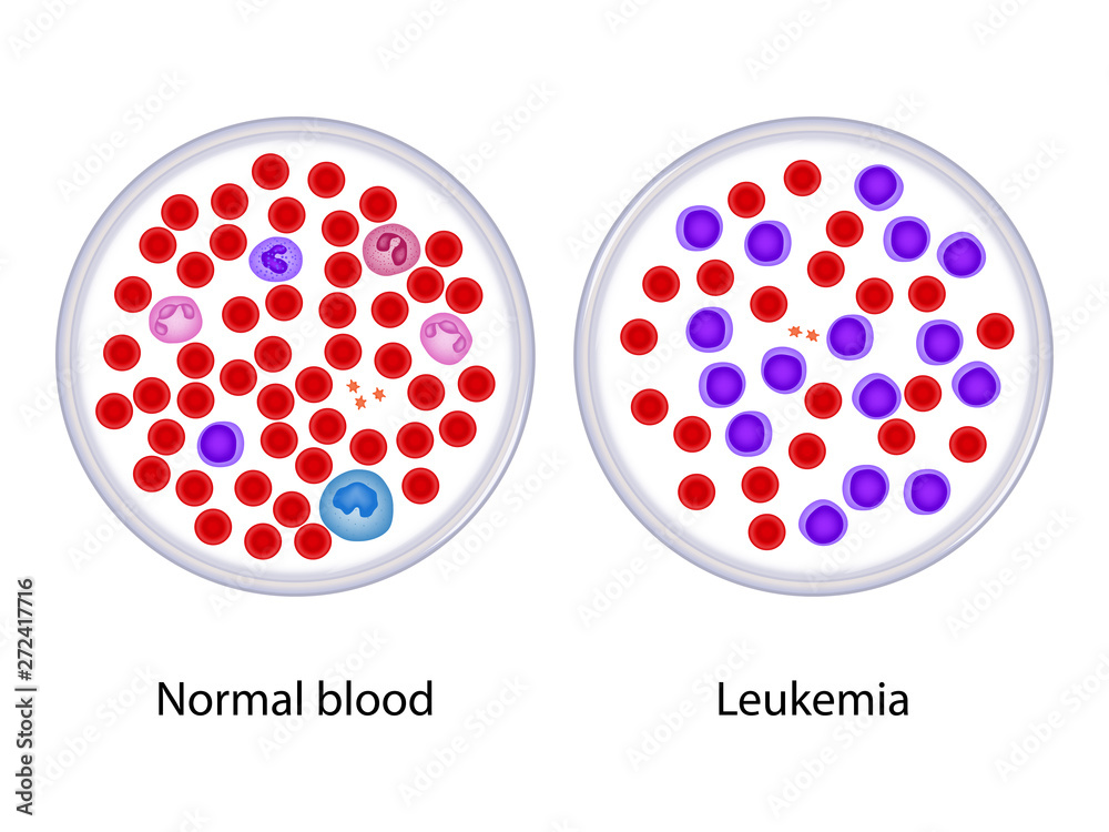 Comparison between Normal blood and Leukemia vector ESP10 Stock Vector ...
