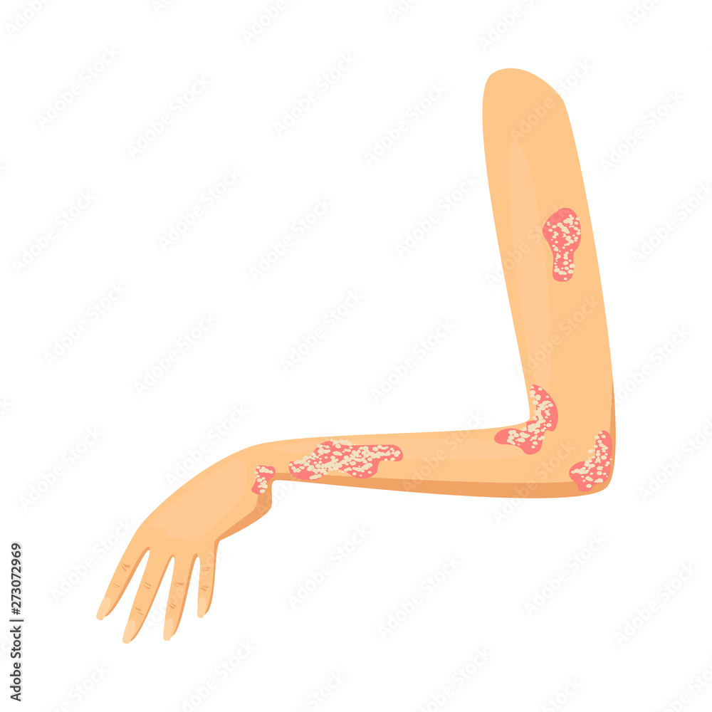 Vector illustration of psoriasis and dermatitis icon. Set of psoriasis ...
