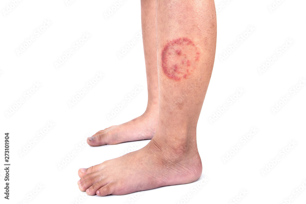 Ringworm infection or Tinea corporis on skin isolated on white ...