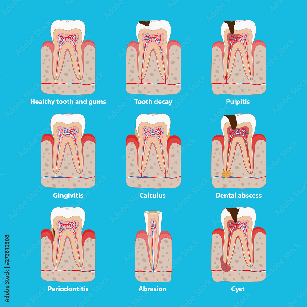 Popular teeth diseases icons in flat design, vector medical ...