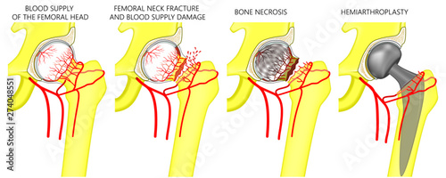 Vector illustration of femoral head blood supply, femoral neck fracture ...
