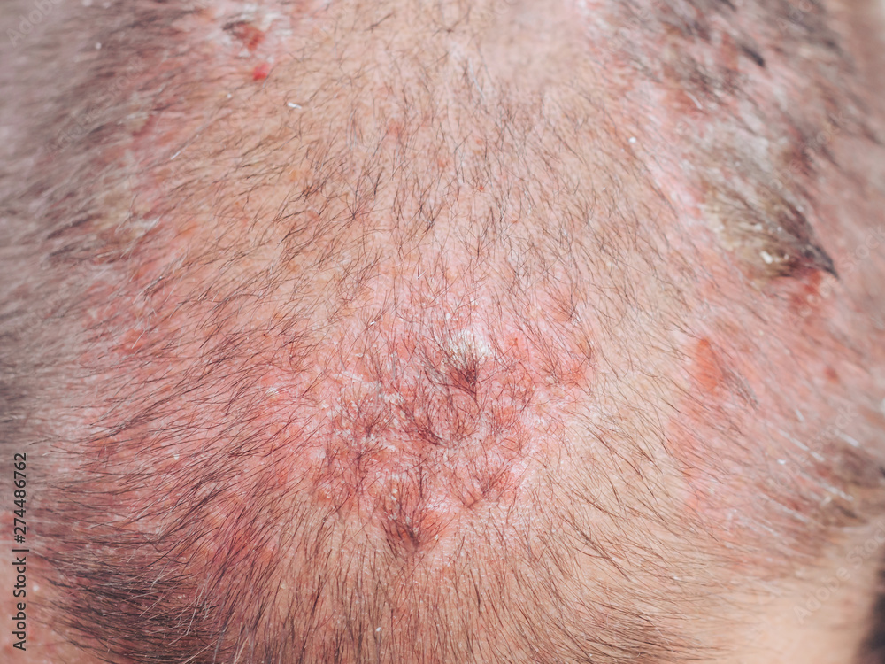 Close-up of irritation, rash on human scalp. Stock Photo | Adobe Stock