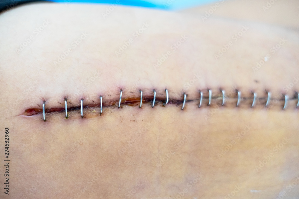 wound sutures in body of patients in the hospital. Wound sewn with ...