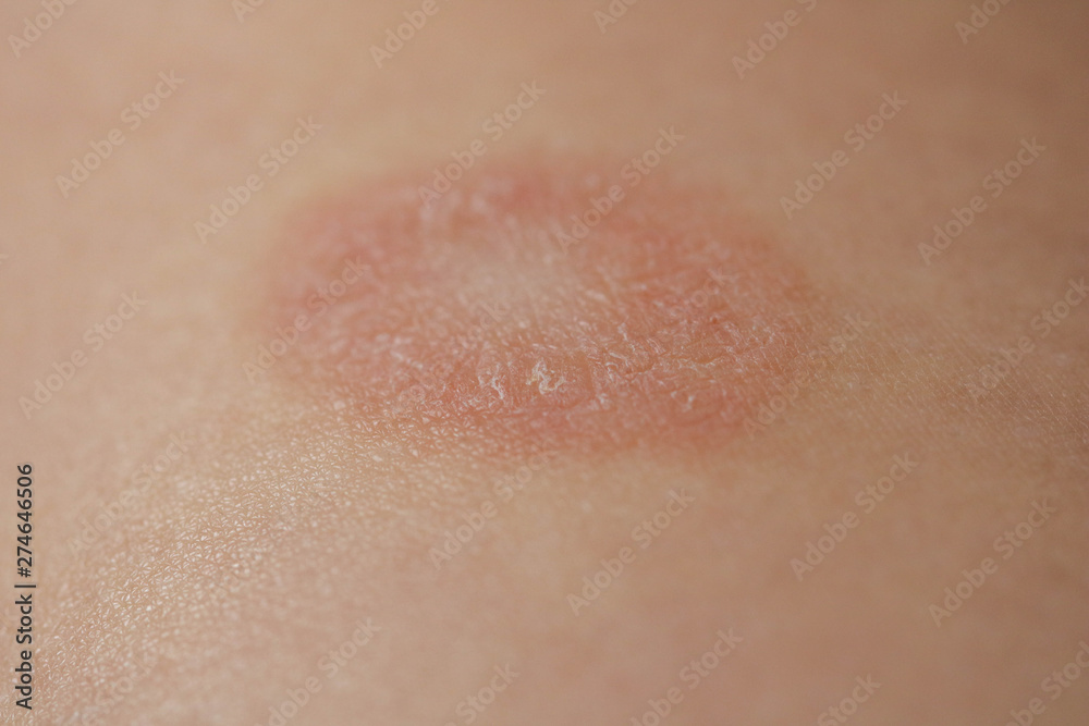 Pityriasis Rosea is a type of dermatitis with a mild pink or red skin ...