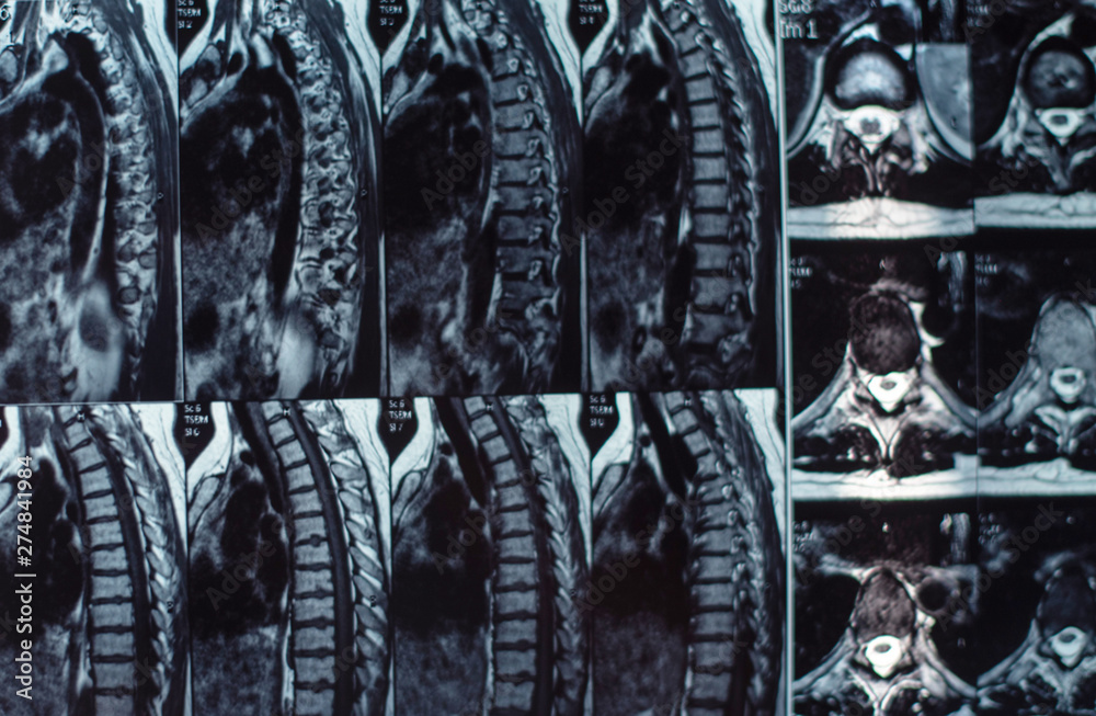 Magnetic resonance imaging of the human spine. Hernia on the spine ...