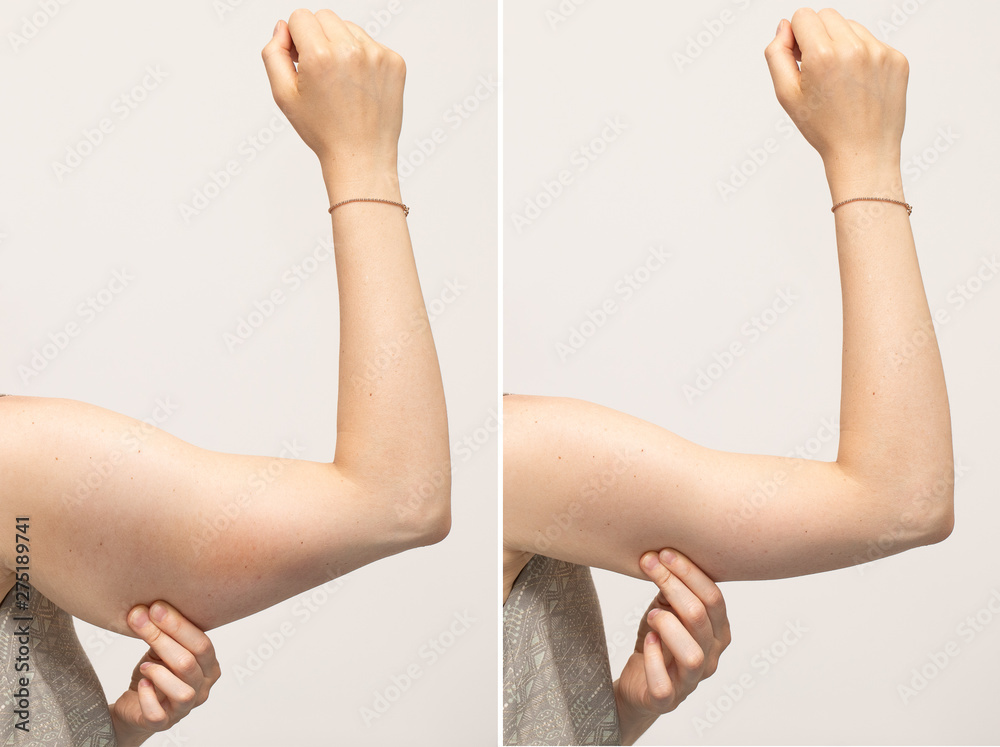 Fotografia do Stock A split screen of a woman pinching the skin beneath ...