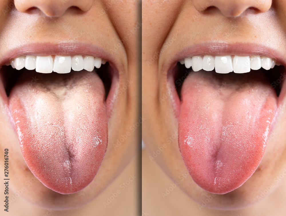 A before and after view of on the tongue of a Caucasian girl she sticks her