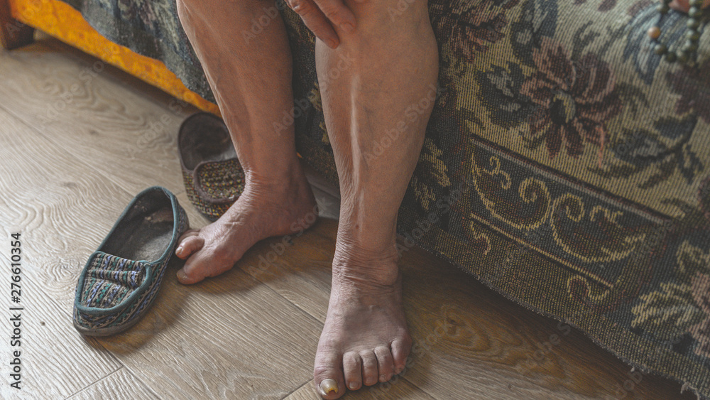 old feet, damaged toes and wrinkled legs with veins of old woman. Old ...