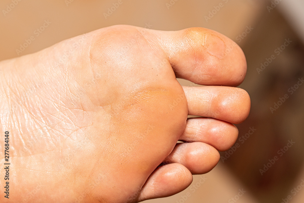 An extreme closeup view on the foot sole of a Caucasian girl. Underside ...