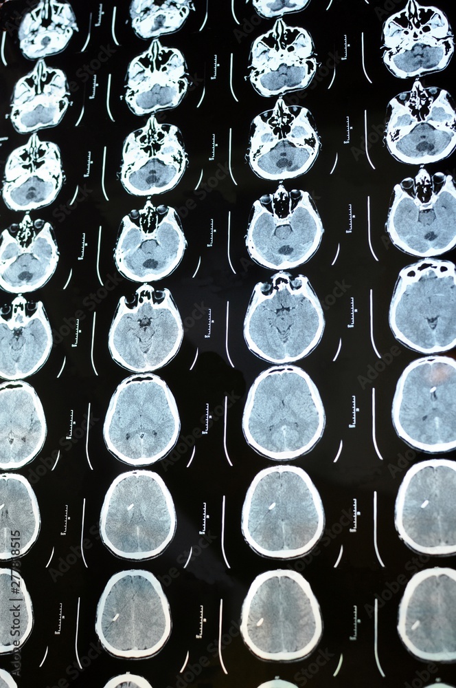 anatomy, bone, brain, colloid cyst, computed tomography, cranium, ct ...