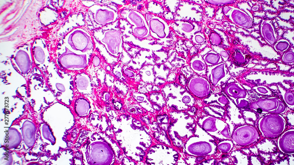 Histopathology of prostate gland hyperplasia, light micrograph, photo ...
