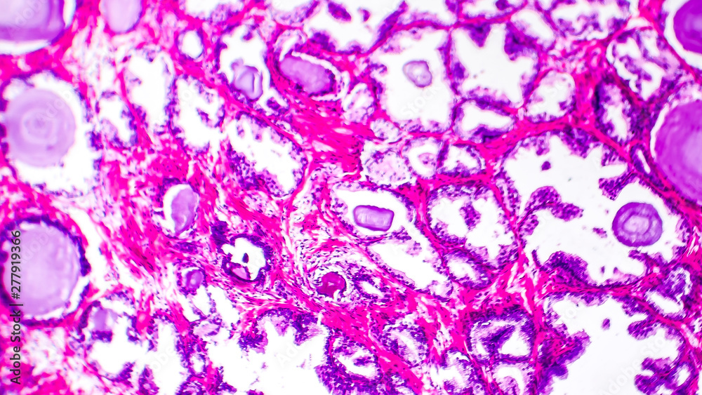 Histopathology of prostate gland hyperplasia, light micrograph, photo ...