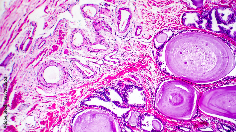 Histopathology of prostate gland hyperplasia, light micrograph, photo ...