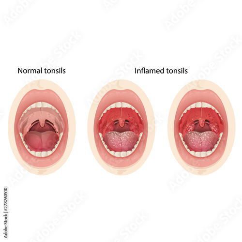 Normal and inflamed tonsils. Illustration of a throat bacterial and ...