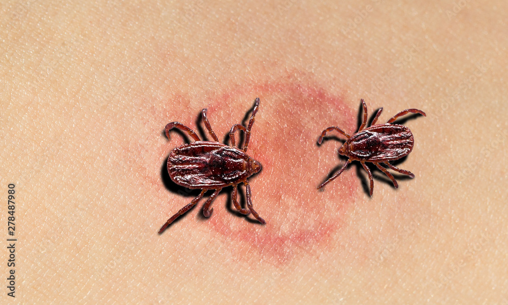 A close up view of a painful, red and inflamed tick bite with two small ...