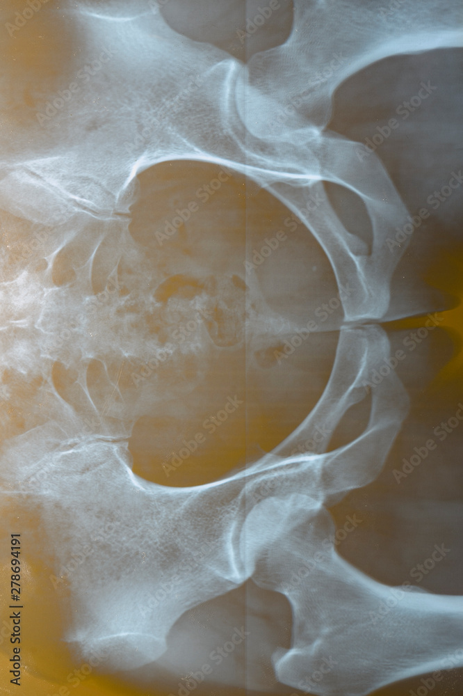 x-ray of the female hip joint, female problems, uterine and ovarian ...