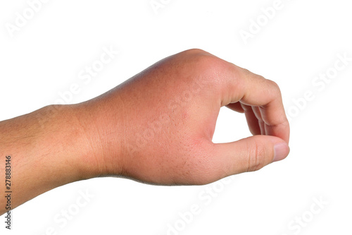 Inflammation, swelling, redness of the hand shows infection. Insect ...