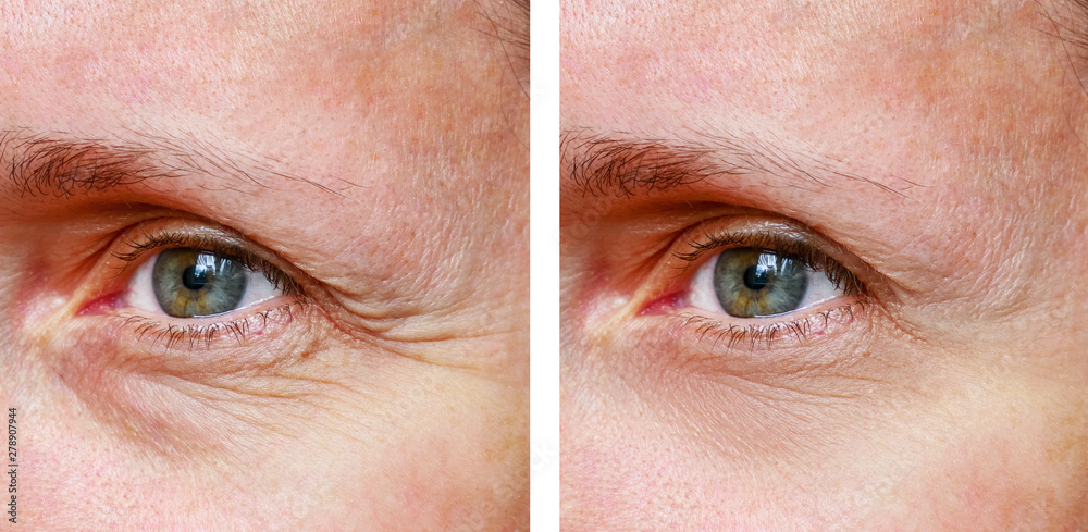 Procedure for the rejuvenation of wrinkles around the eyes, crow's feet ...