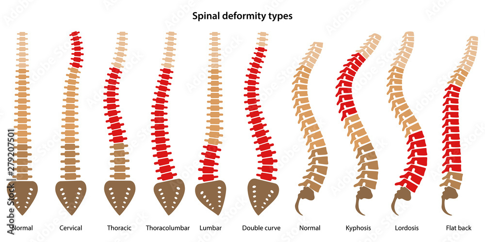 Spinal deformity types. Anterior view and lateral view of spinal ...
