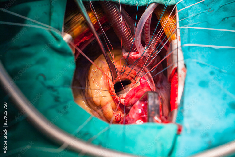 Fotografie Mitral valve orifice in surgeon view. The pathologic mitral ...