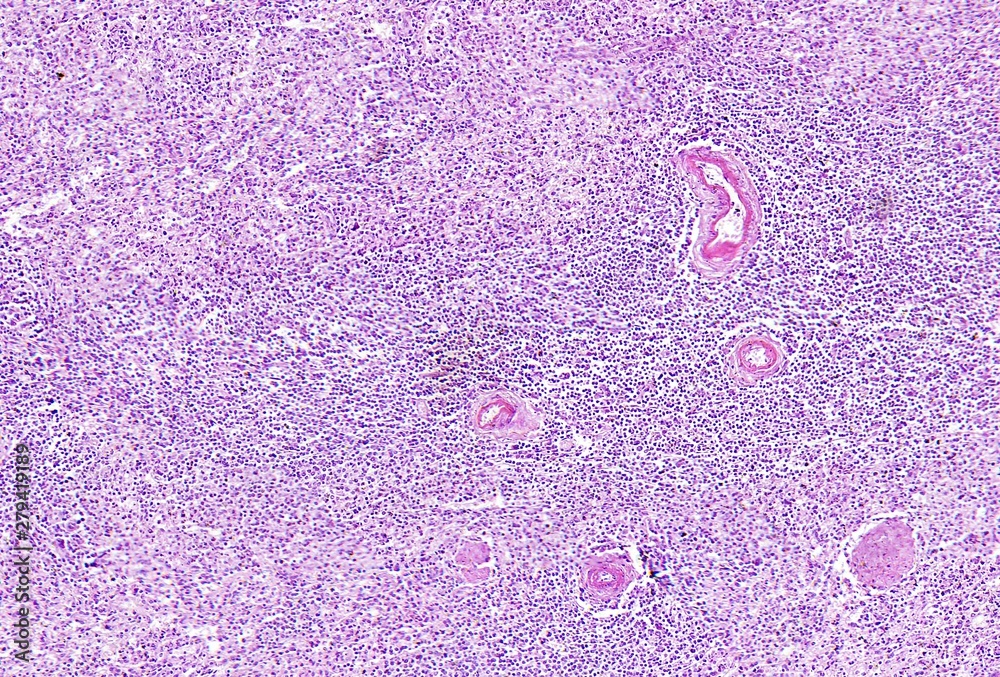 Histology of human tissue, show central artery hyaline degeneration of ...