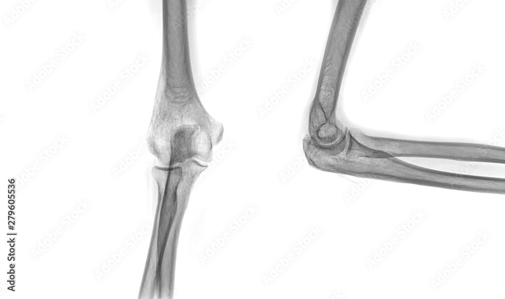 X-ray Elbow or Radiography of Right elbow AP and Lateral view for ...