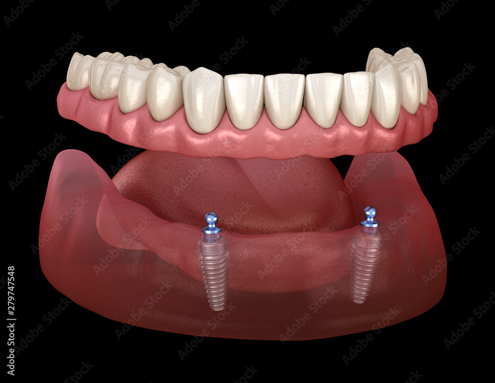 Mandibular removable prosthesis All on 2 system supported by implants ...