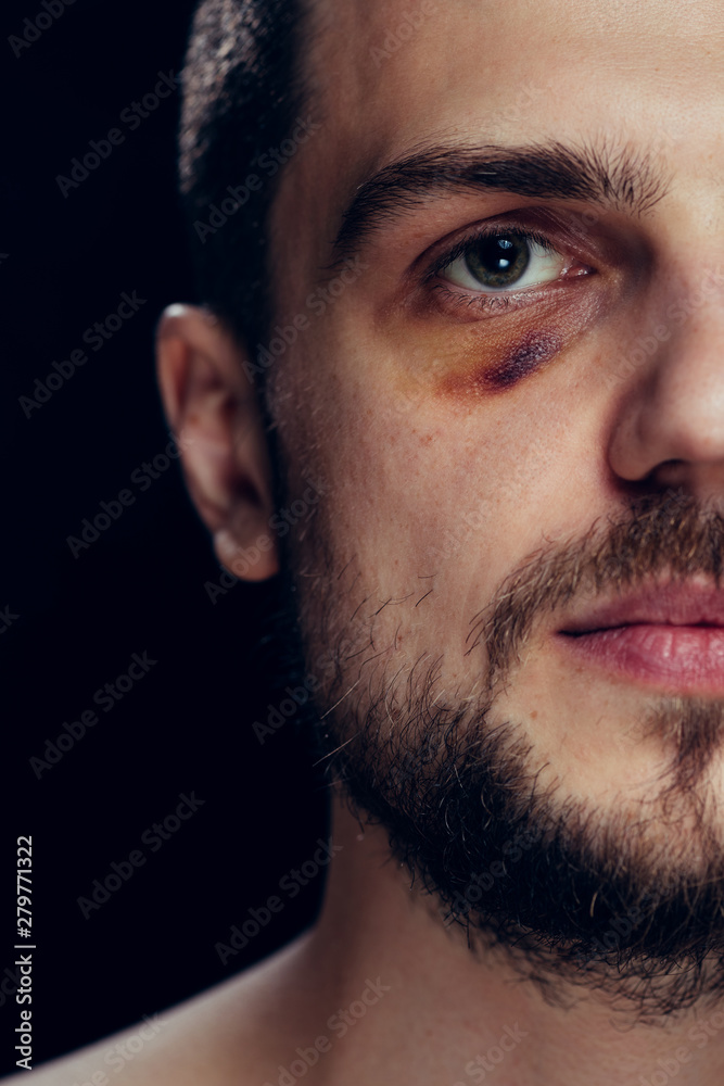 Violence fight eye hematoma shiner close-up. Portrait of a man with ...