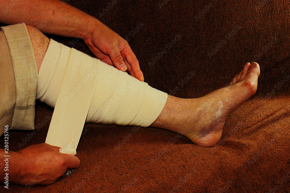 Men's leg with swelling and bruises after stretching the calf muscles ...