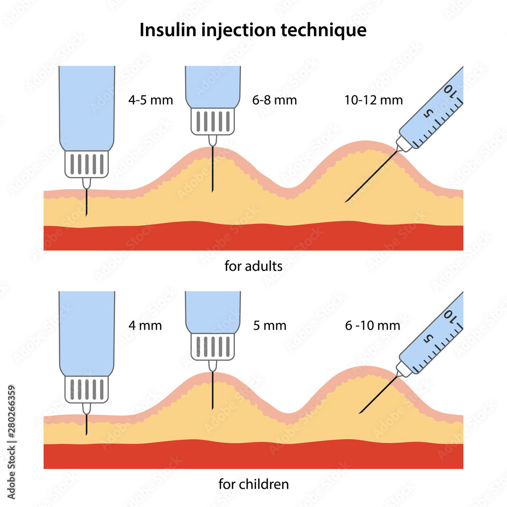 Insulin injection technique in diabetes for adults and children ...