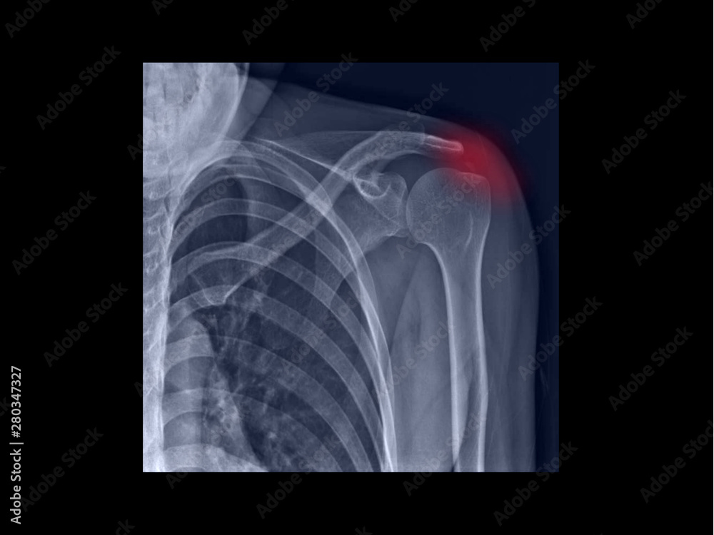 Film X-ray shoulder radiograph showing calcium deposit on rotator cuff ...