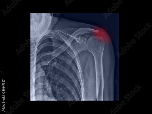 Film X-ray shoulder radiograph showing calcium deposit on rotator cuff ...