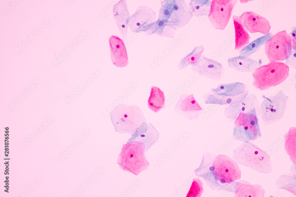 View in microscopic of abnormal human cervix cells.Squamous epithelium ...