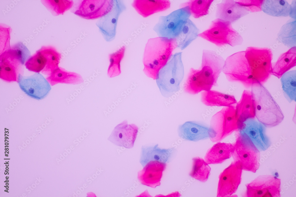 View in microscopic of abnormal human cervix cells.Squamous epithelium ...