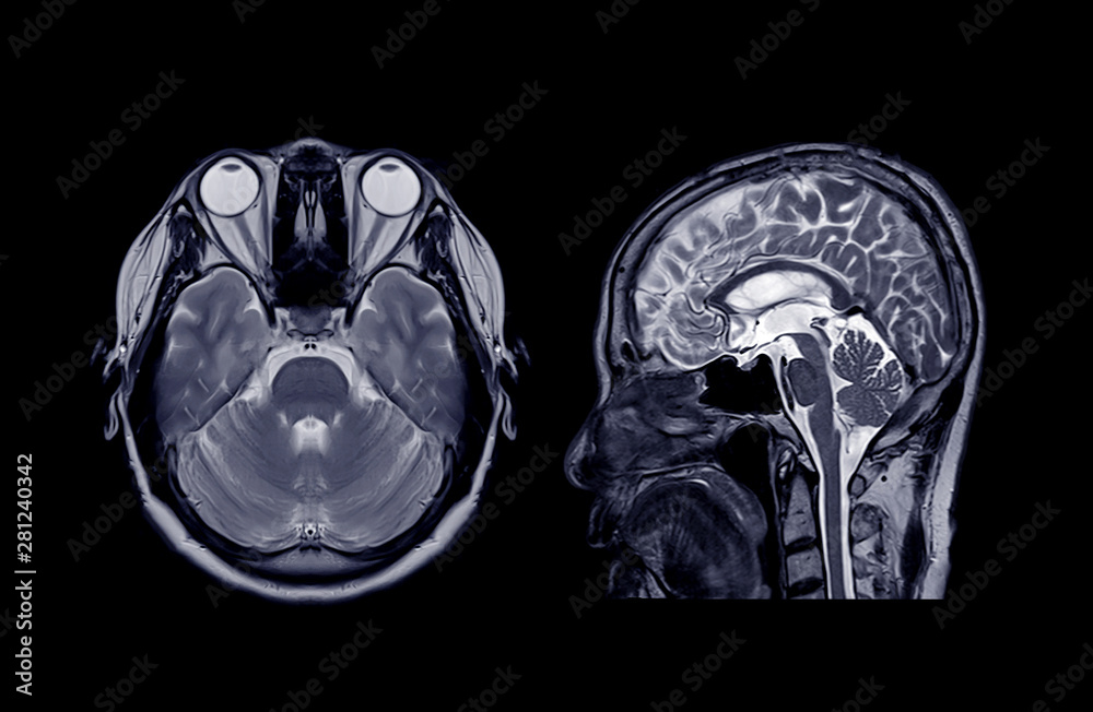 MRI of the brain axial and Coronal plane for detect Brain disease ...