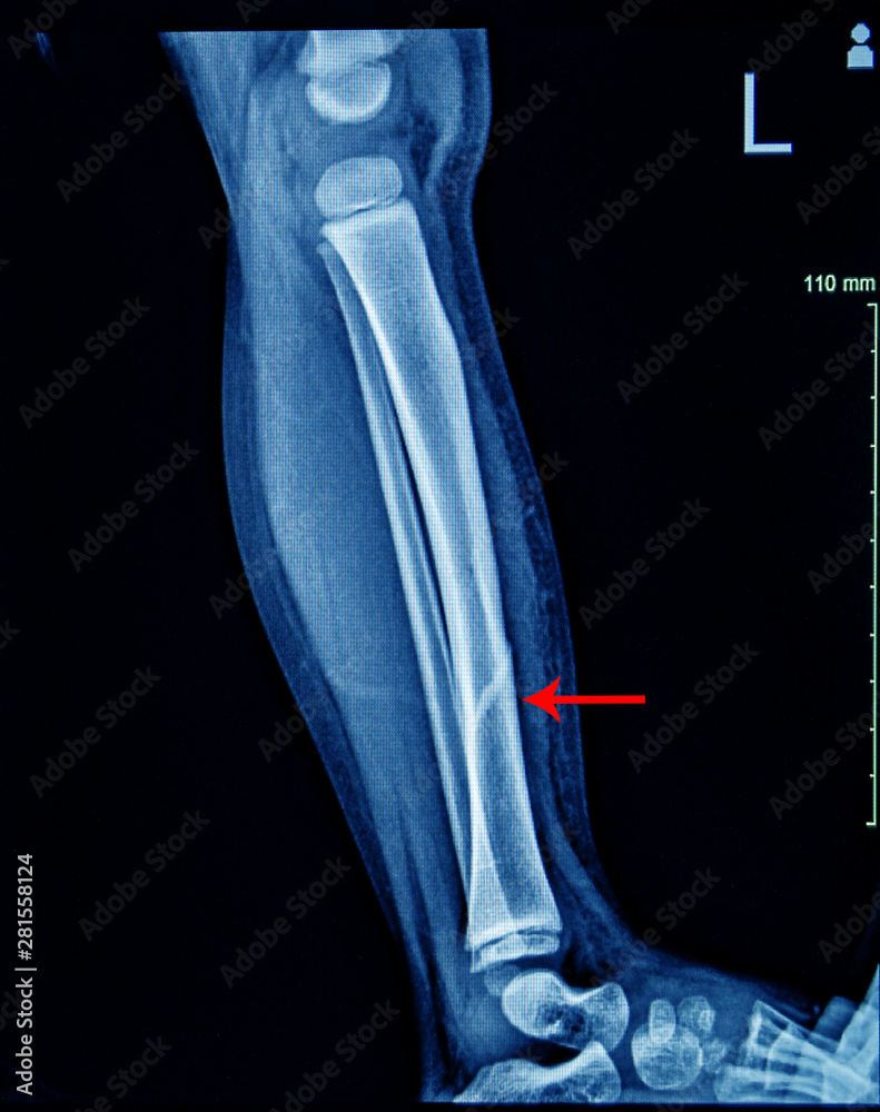X-ray Left Leg AP Lat fracture Tibia. Stock Photo | Adobe Stock