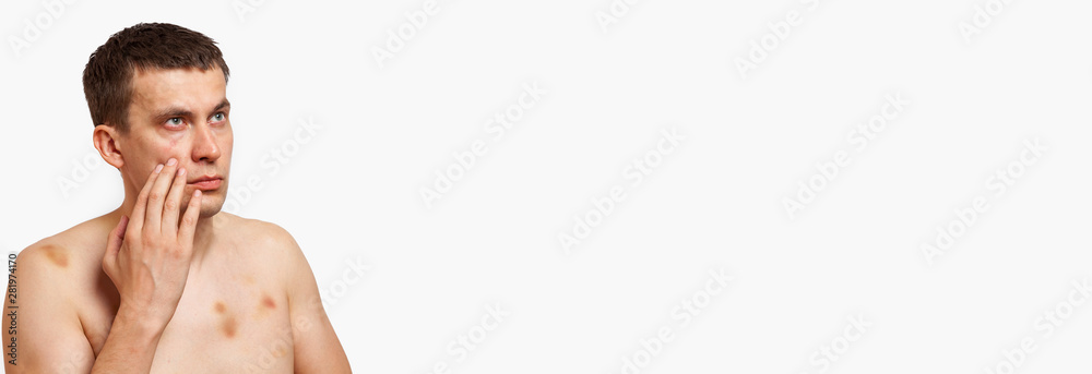 Stock-Foto „Brunette man with bruises on his body holds his hand to his ...