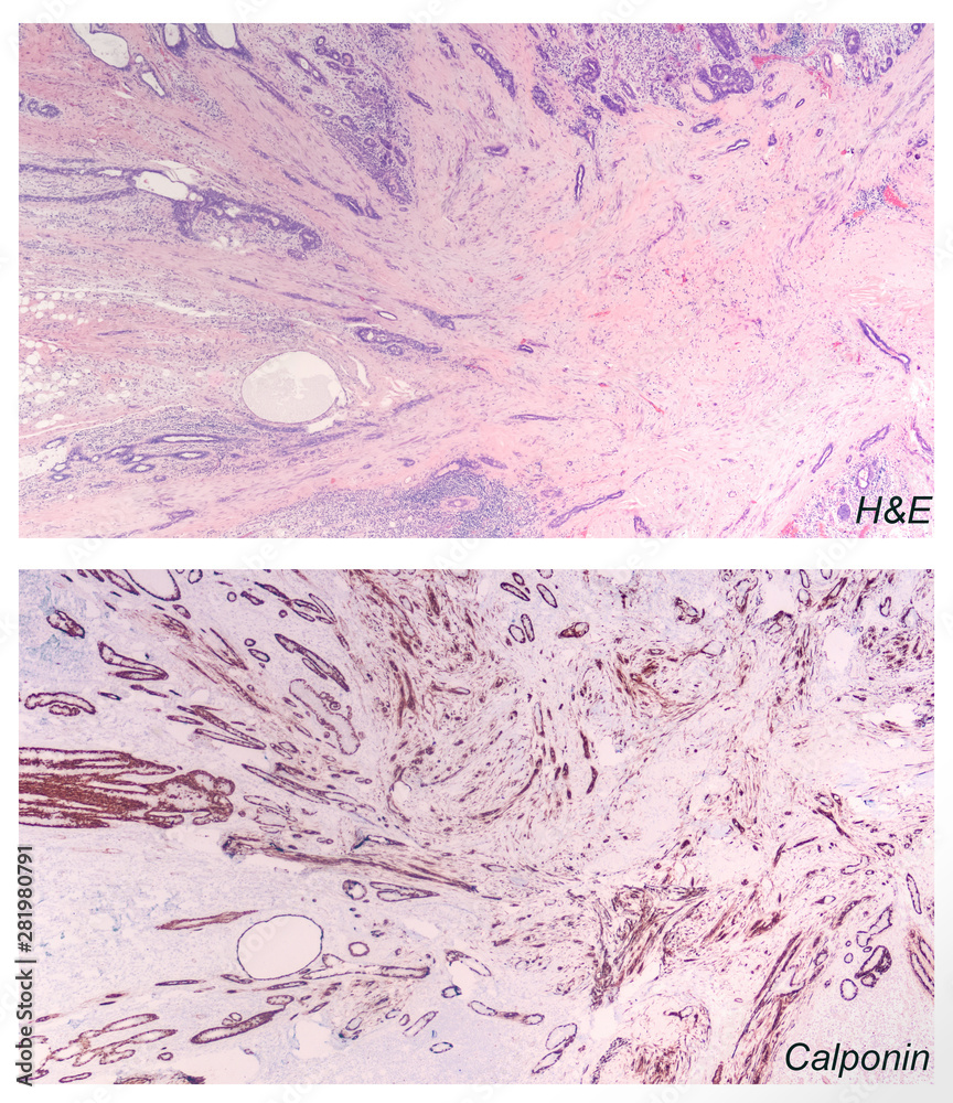 Radial scar of the breast is a benign lesion that can mimic cancer by ...
