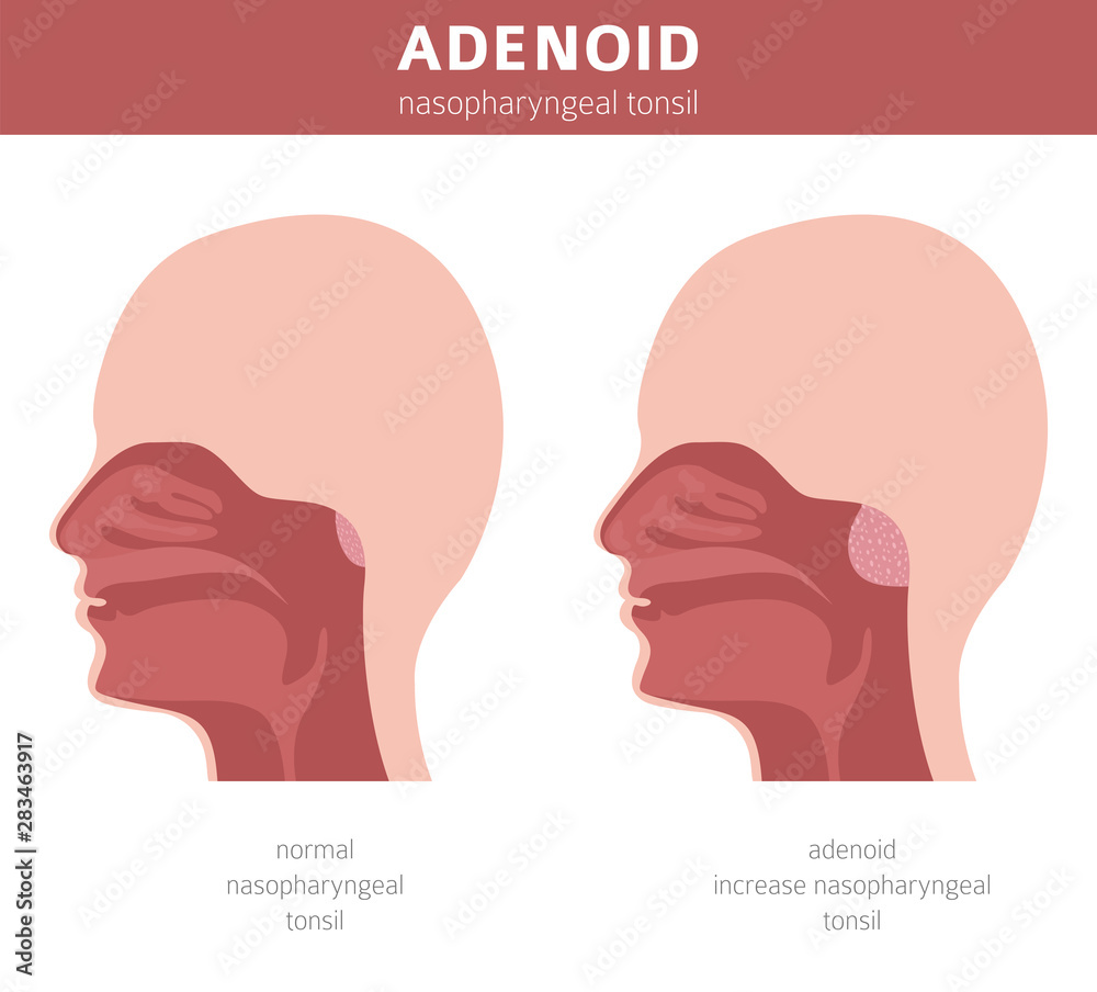 Nasal and throat, nasopharynx diseases. Adenoids diagnosis and ...