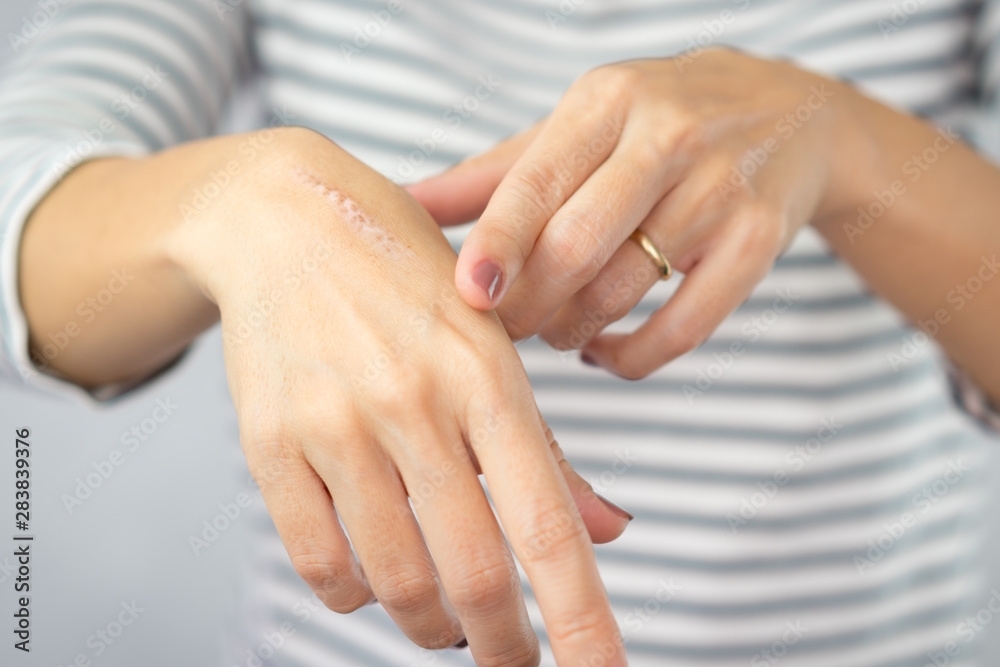 Photo Stock Close up of cooking oil burn scar on a woman's hands. The ...