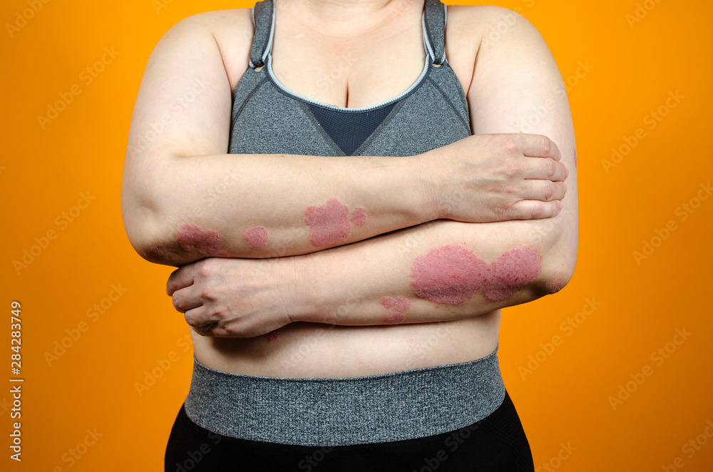 Dermatological skin disease. psoriasis, eczema, dermatitis, allergies ...