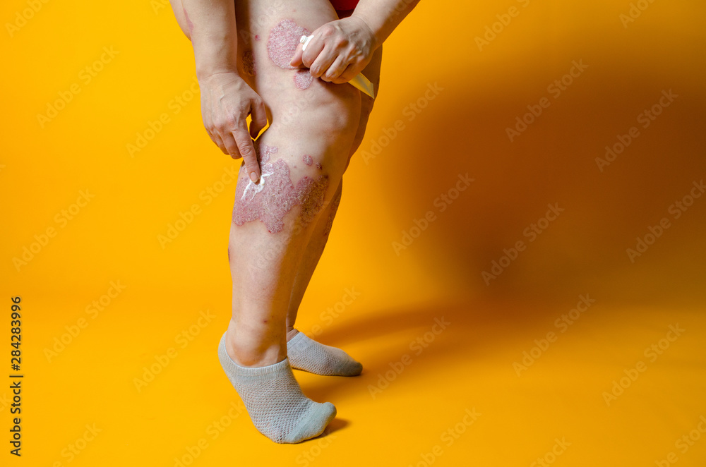 Dermatological skin disease. psoriasis, eczema, dermatitis, allergies ...