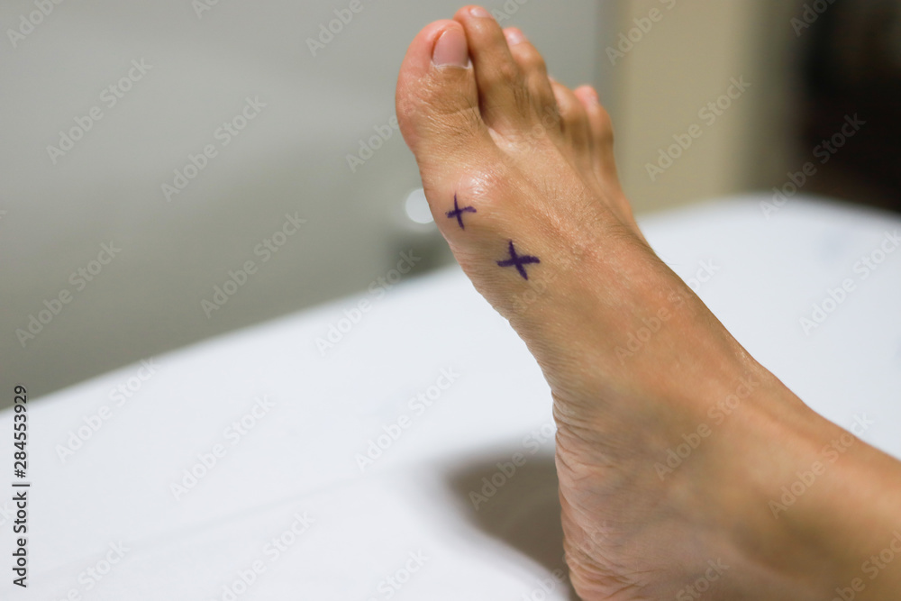 A doctor mark an Asian girl's feet Hallux Valgus before and after ...