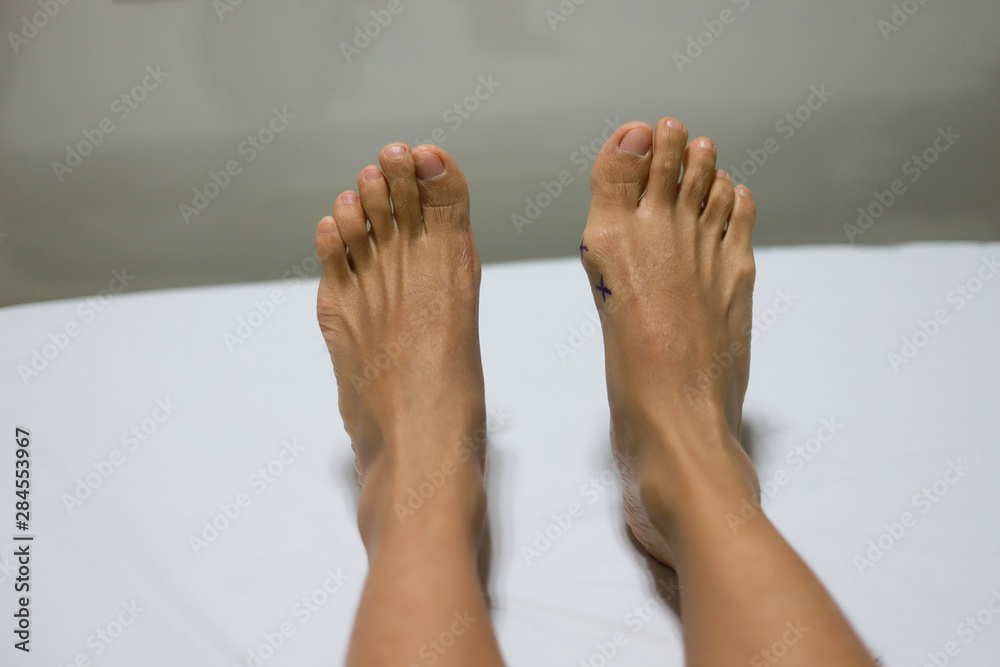 Hallux Valgus in an Asian girl before and after Proximal phalanx ...