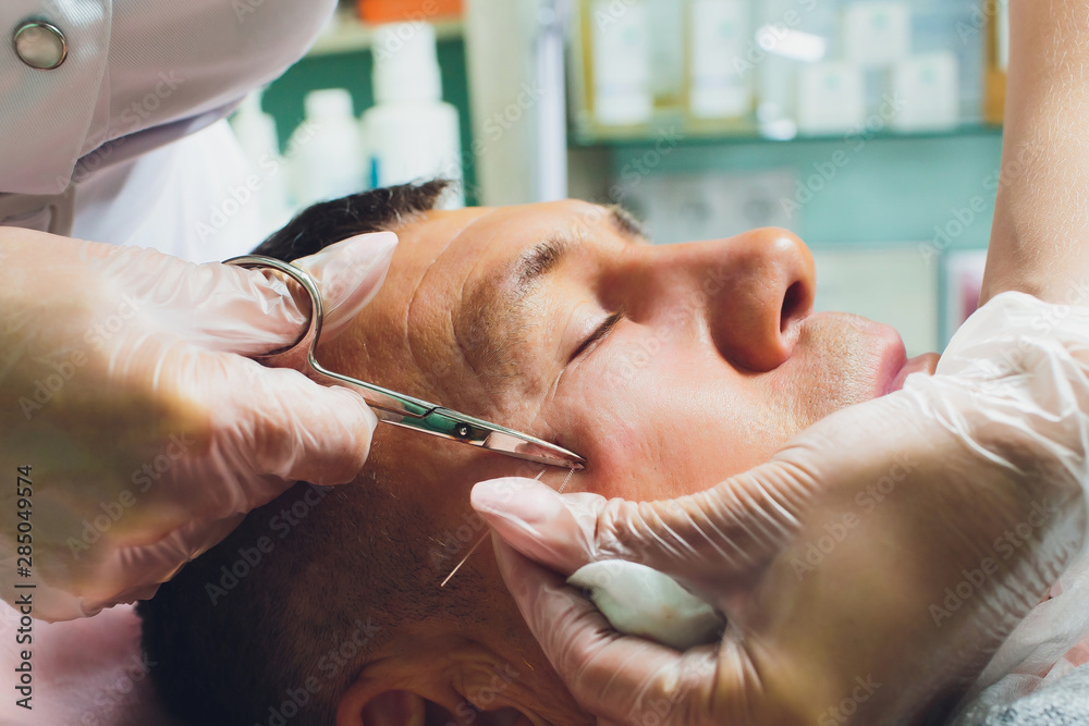 Stock-Foto „Close-up of procedure for face lifting PDO Suture operation ...