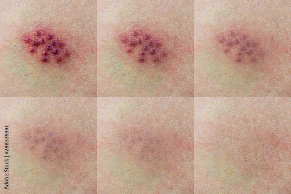 Virus on the body. Rash of Shingles on the skin. Bright red blisters of ...
