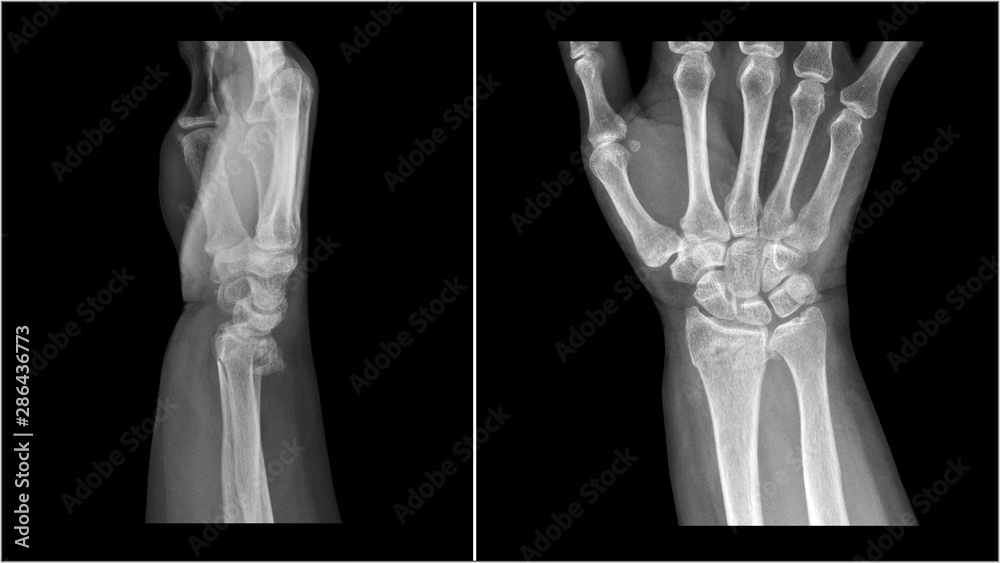 Film X ray wrist radiograph show distal forearm bone broken ( distal ...