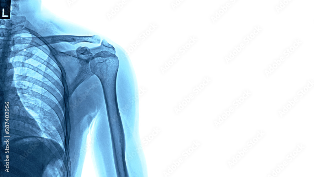 X-ray image of shoulder pain, shoulder ligament tendinitis, shoulder ...