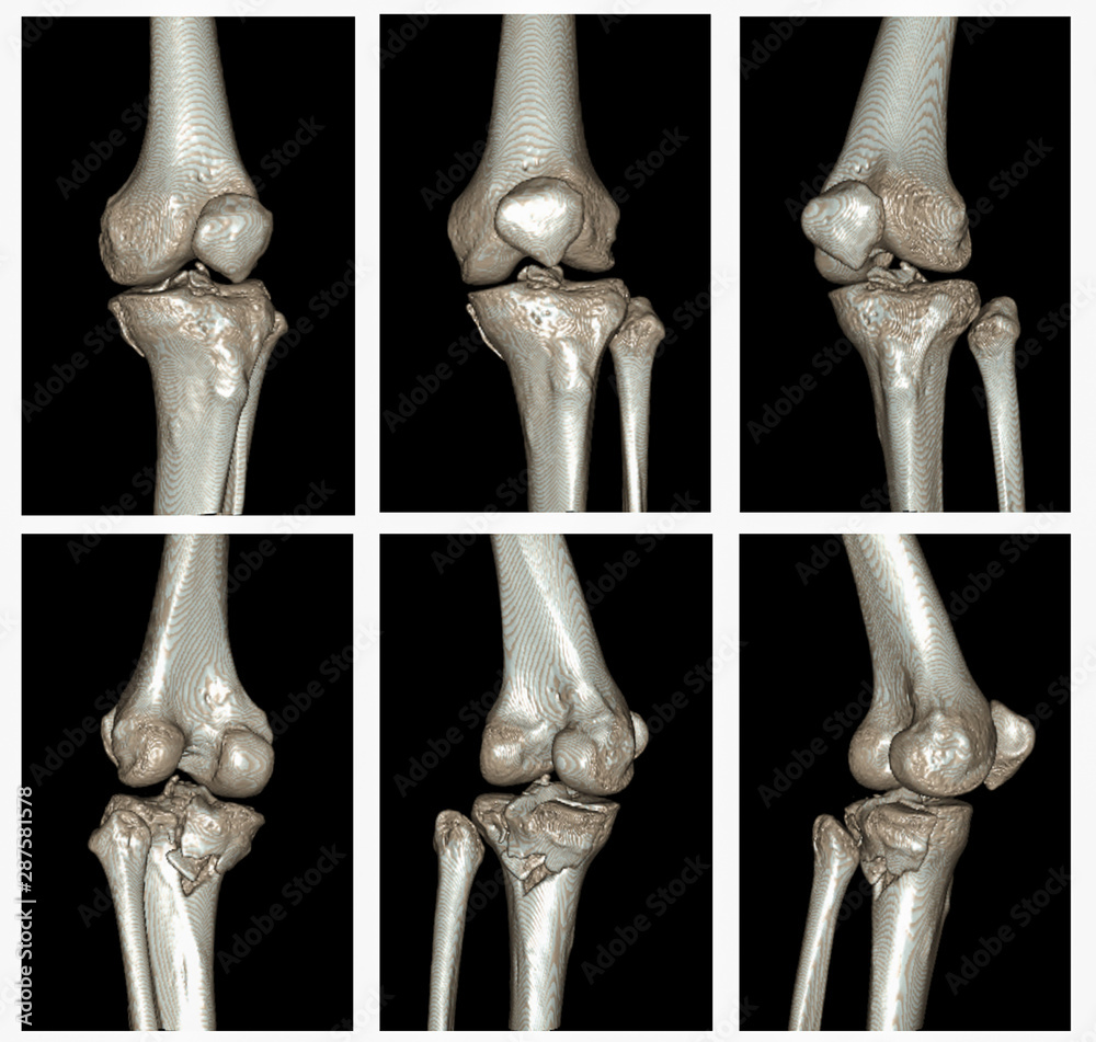 Magnetic resonance imaging (MRI) 3D reconstruction showing the knee ...
